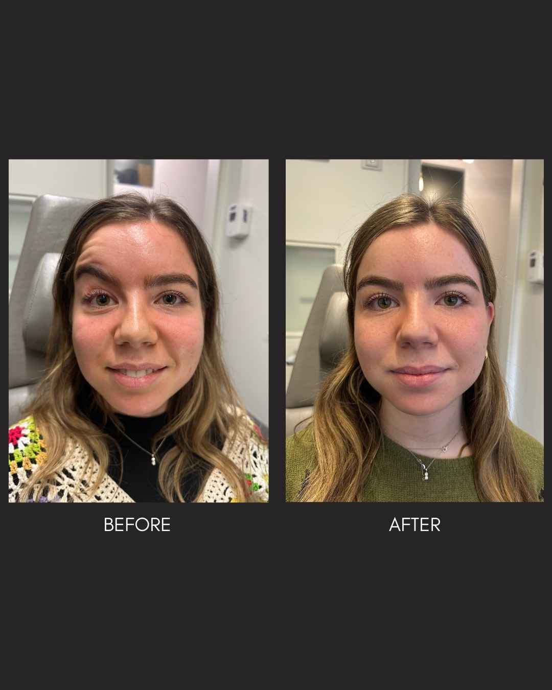 Botulinotoxin NYC – Smooth Wrinkles & Refresh Your Look